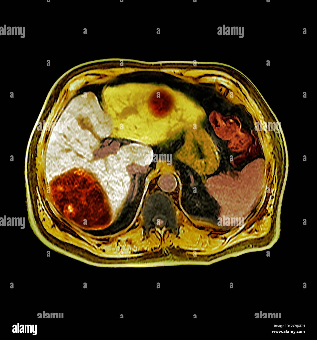 Leberkrebs. Farbige axiale Computertomographie (CT) Scan durch den ...