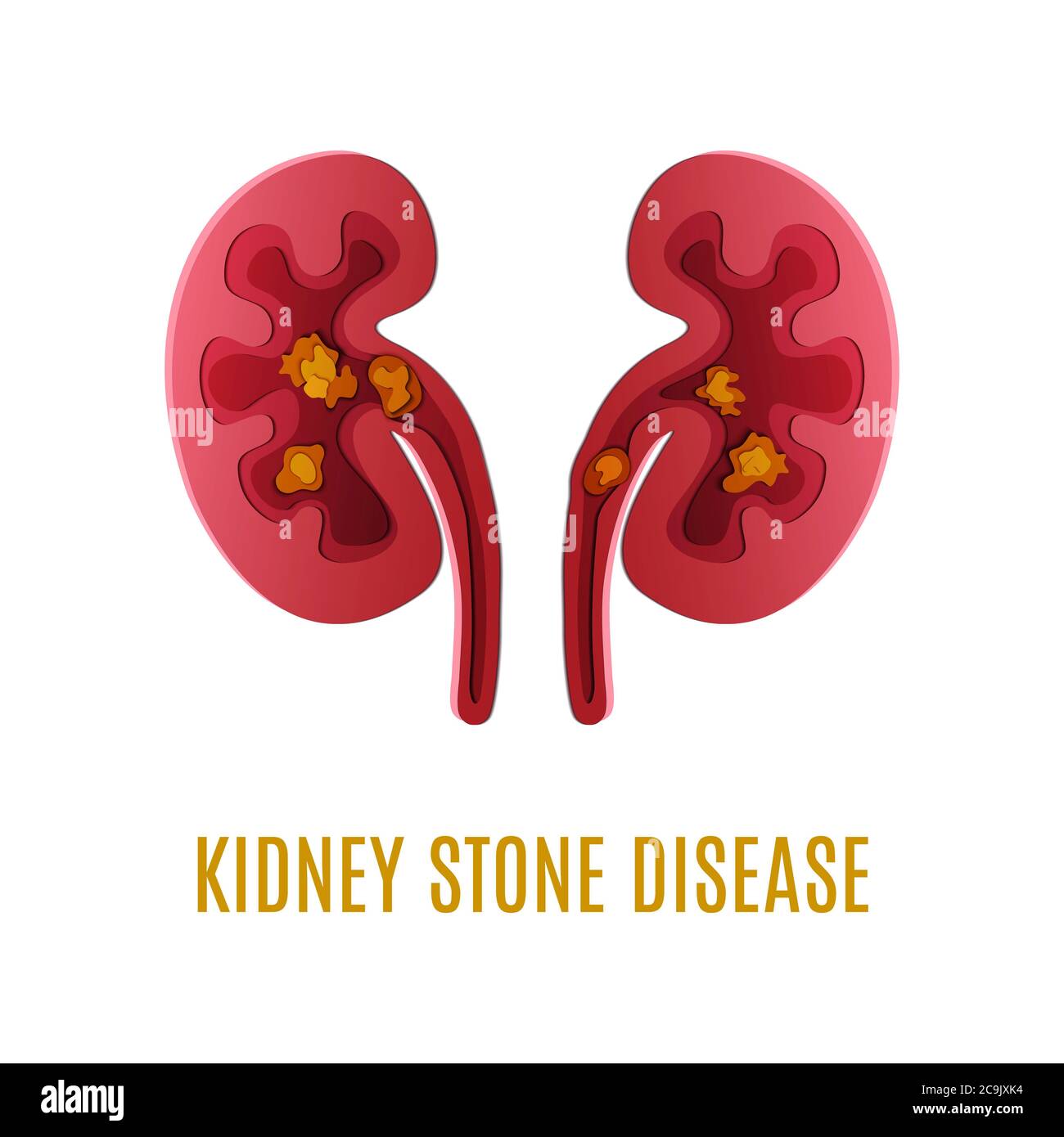 Urinary stones -Fotos und -Bildmaterial in hoher Auflösung – Alamy