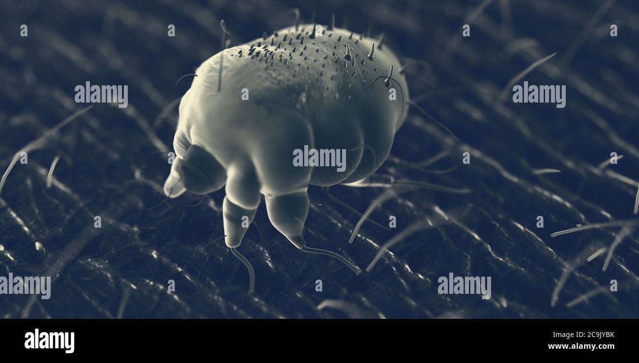 Krätze Milbe auf der menschlichen Haut, Computer-Illustration ...
