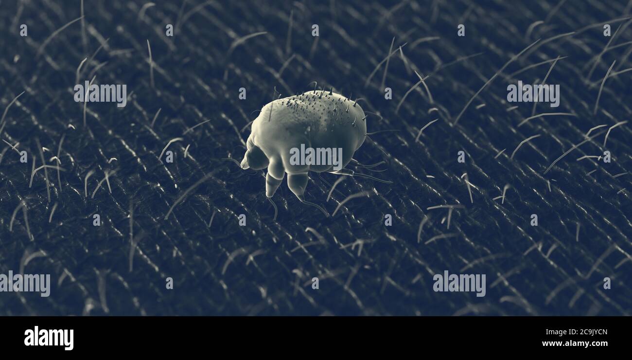 Krätze Milbe auf der menschlichen Haut, Computer-Illustration ...