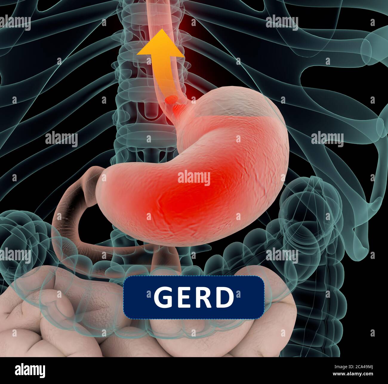 Saurer Rückfluss, GERD. Gastroösophageale Refluxkrankheit. Magen und ...
