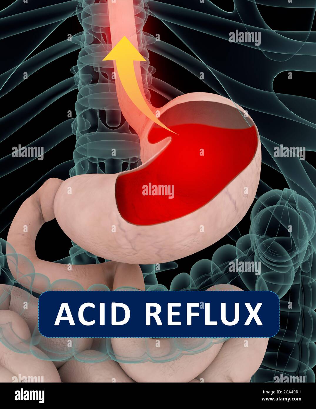 Saurer Rückfluss, GERD. Gastroösophageale Refluxkrankheit. Magen und ...
