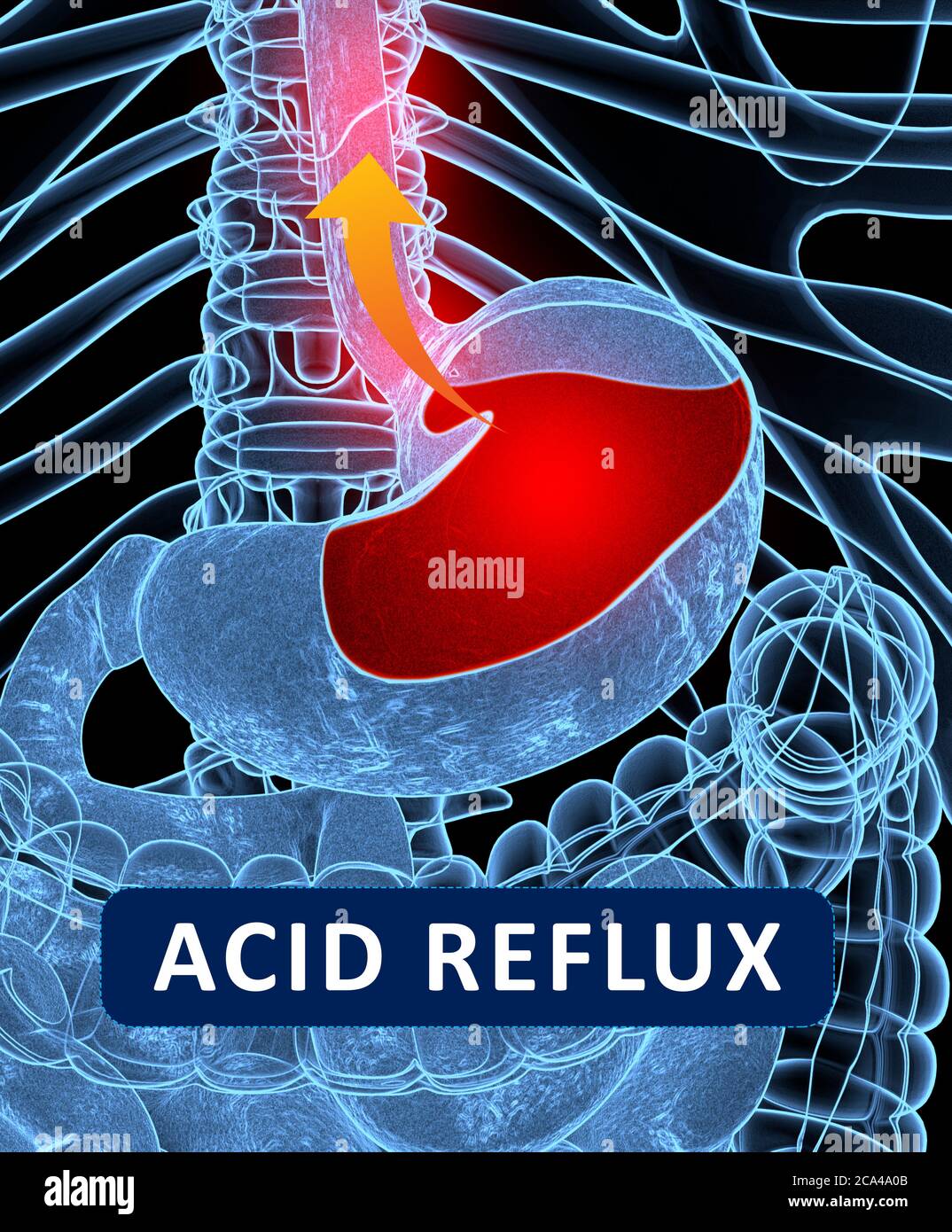 Saurer Rückfluss, GERD. Gastroösophageale Refluxkrankheit. Magen und ...