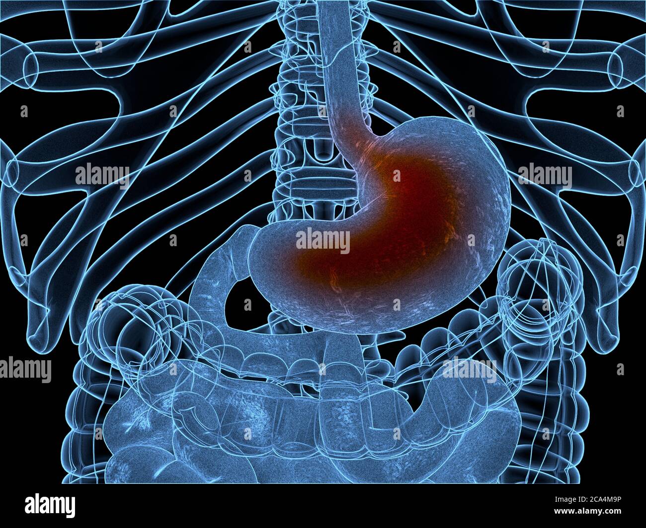 Saurer Rückfluss, GERD. Gastroösophageale Refluxkrankheit. Magen und ...