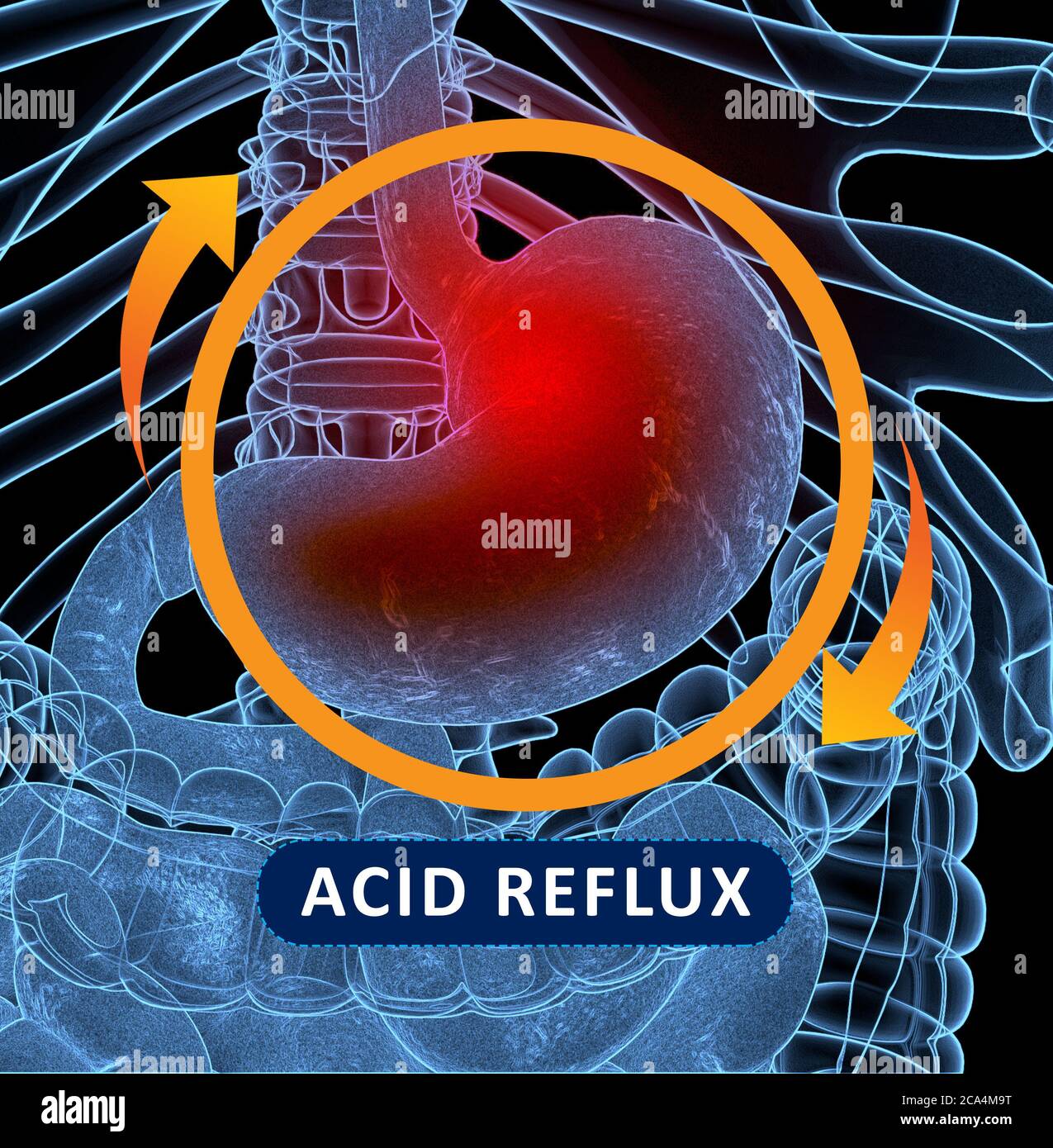 Saurer Rückfluss, GERD. Gastroösophageale Refluxkrankheit. Magen und ...