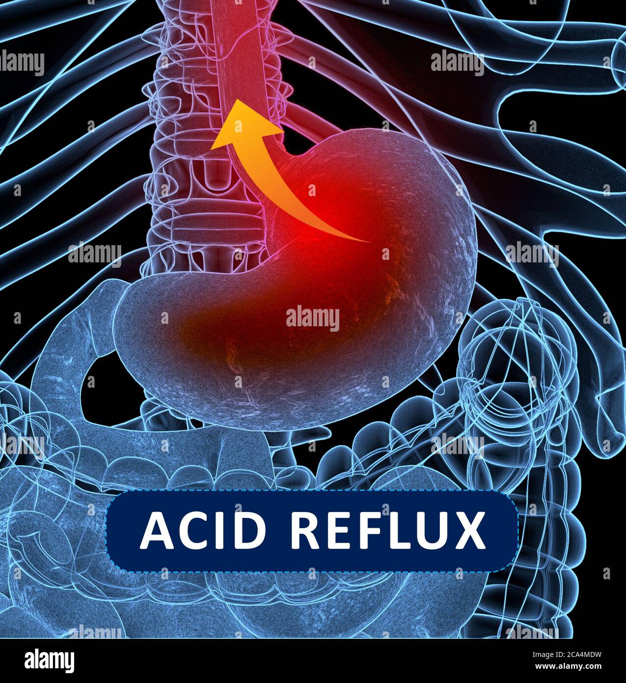 Saurer Rückfluss, GERD. Gastroösophageale Refluxkrankheit. Magen und ...