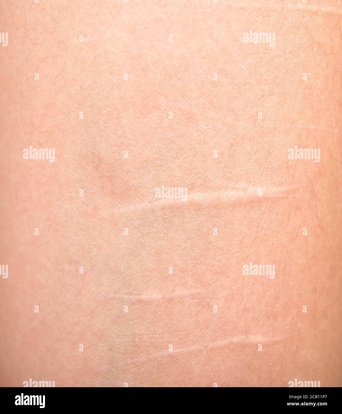 Narben am bauch -Fotos und -Bildmaterial in hoher Auflösung – Alamy