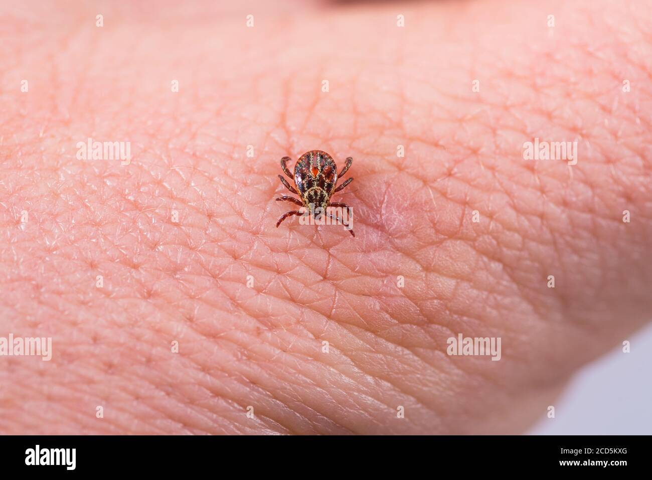 Milbe auf der Haut. Gefahr von Zeckenbiss Stockfotografie - Alamy