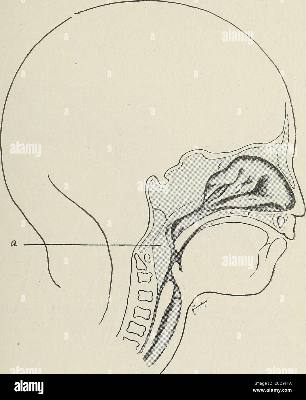 . Die Cleveland Medical Journal . Der Nasopharynx bei einem Kind ist ...