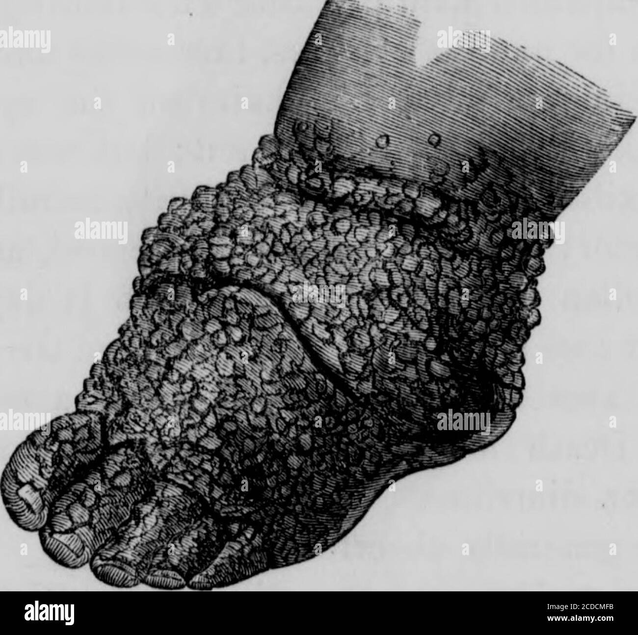 Elephantiasis der hand -Fotos und -Bildmaterial in hoher Auflösung – Alamy