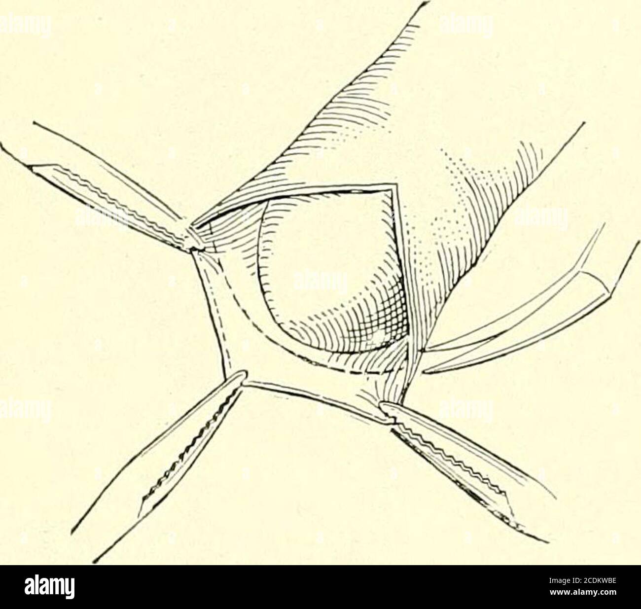 Operation circumcision -Fotos und -Bildmaterial in hoher Auflösung – Alamy
