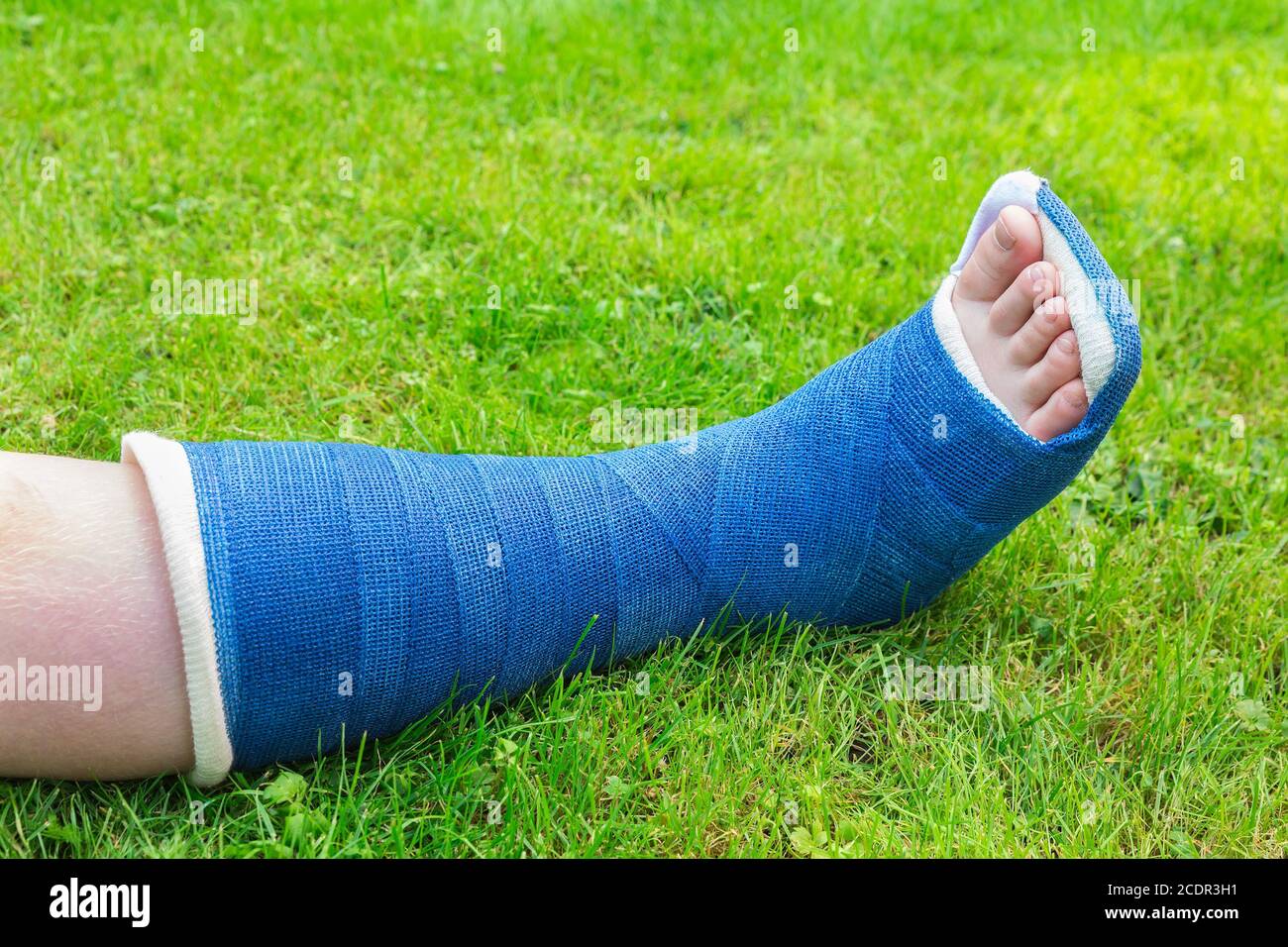 Stilvolle Gips Am Fuss Bilder