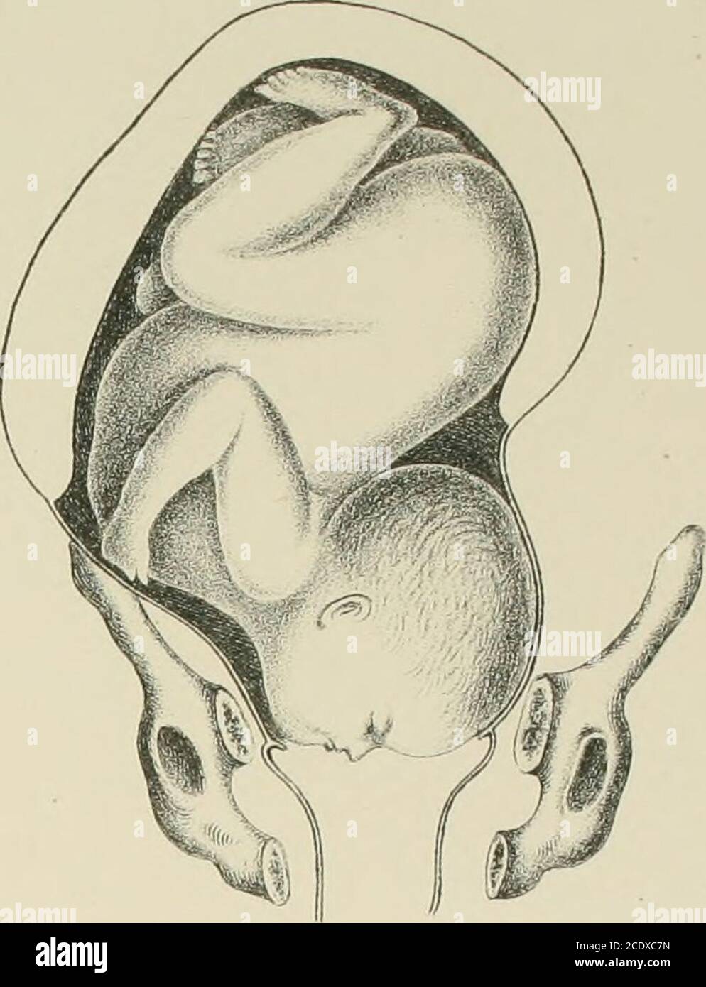 . Über Ruptur der Gebärmutter und ihre Mechanik : nach klinischen ...