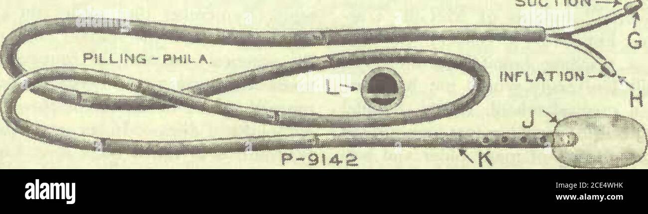 Miller Abbott Tube The Miller Abbott Tube : Two Complications In Its