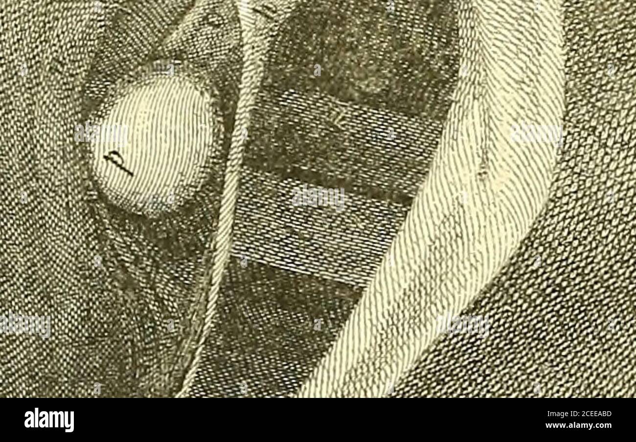 Die anatomie und chirurgische behandlung von hernien -Fotos und ...