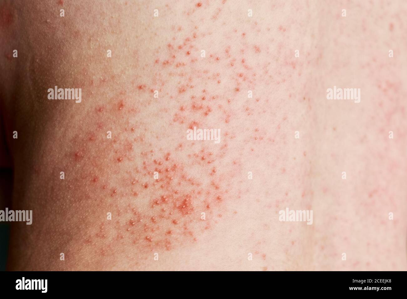 Allergic Rash Stockfotos und -bilder Kaufen - Alamy
