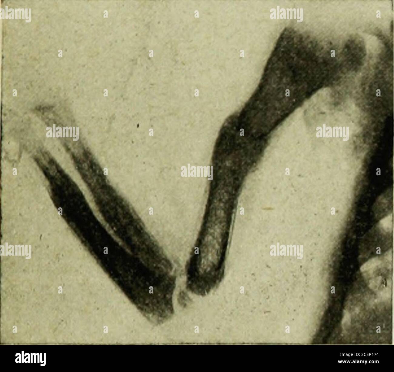 Innerer kondylus Stockfotos und -bilder Kaufen - Alamy