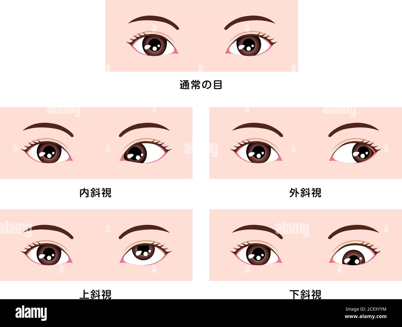 Strabismus esotropie -Fotos und -Bildmaterial in hoher Auflösung – Alamy