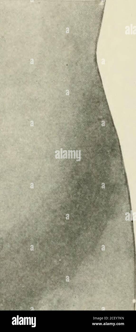 . Bauchhernie : seine Diagnose und Behandlung. Vor dem Betrieb ...