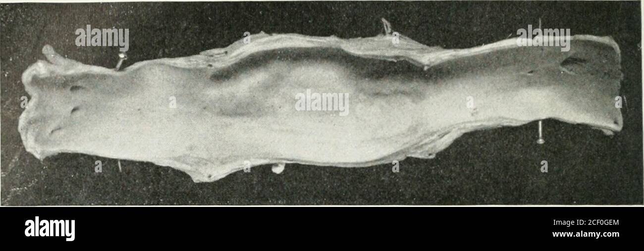 Aorta abdominal y vena cava -Fotos und -Bildmaterial in hoher Auflösung ...