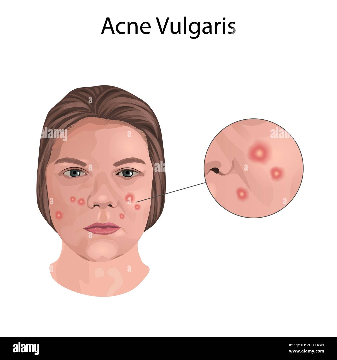 Acne vulgaris -Fotos und -Bildmaterial in hoher Auflösung – Alamy