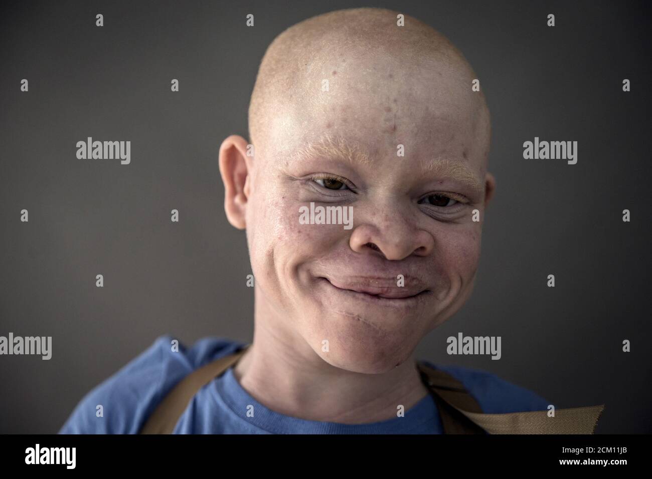 Albino body parts -Fotos und -Bildmaterial in hoher Auflösung – Alamy