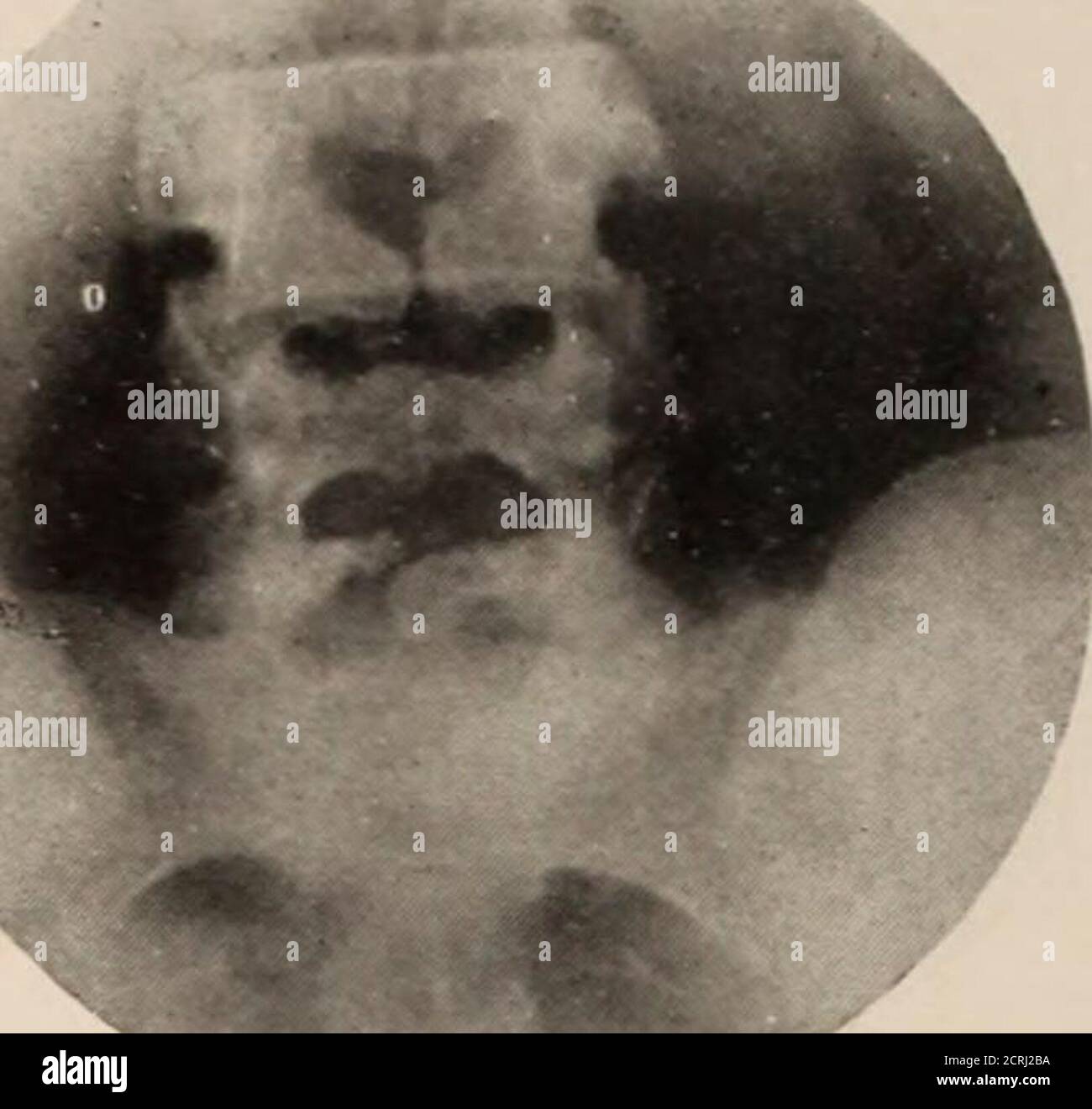 Pes equinus -Fotos und -Bildmaterial in hoher Auflösung – Alamy