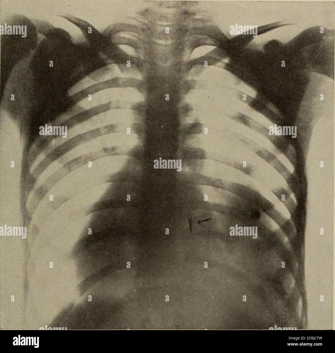 Neunte rippe -Fotos und -Bildmaterial in hoher Auflösung – Alamy