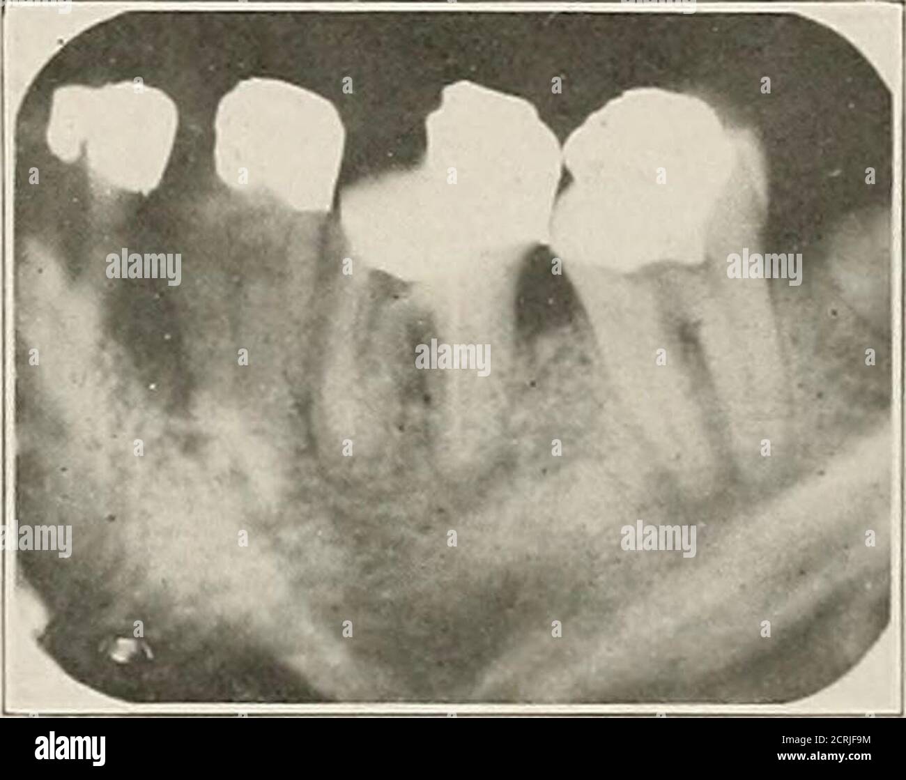 Unterkiefer zweiter molar -Fotos und -Bildmaterial in hoher Auflösung ...