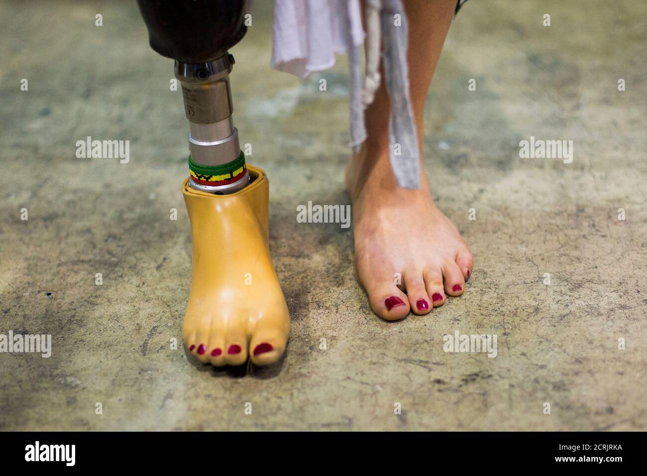 Bein amputierte frau -Fotos und -Bildmaterial in hoher Auflösung – Alamy