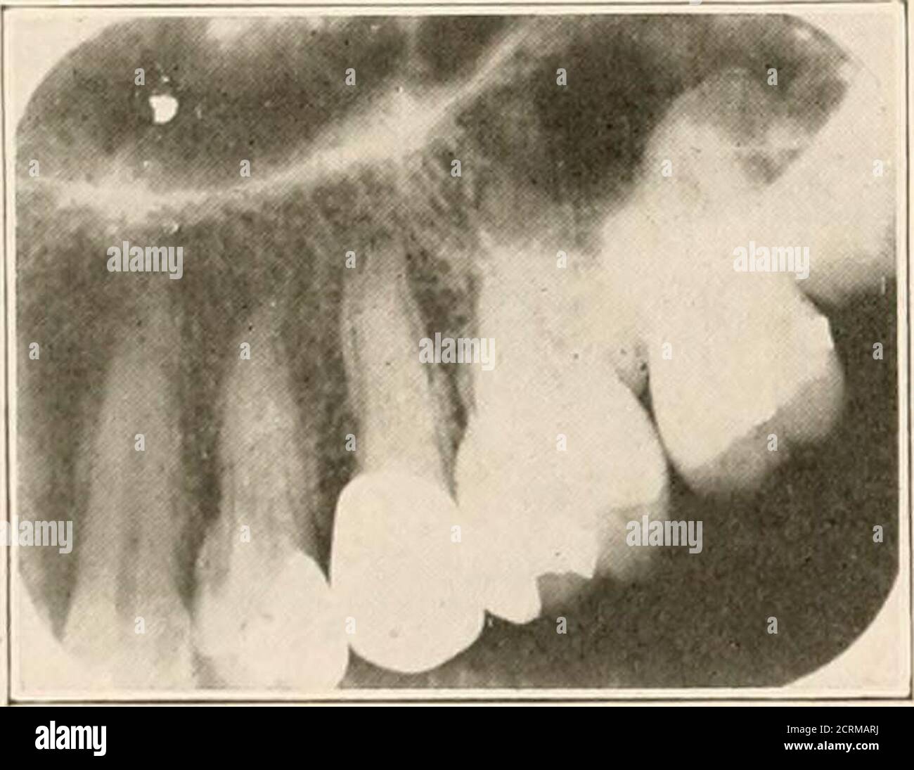 . Interpretation von dentalen & kieferförmigen Roentgenogrammen . Abb. 90. Abb. 91. Abb. 90 ...
