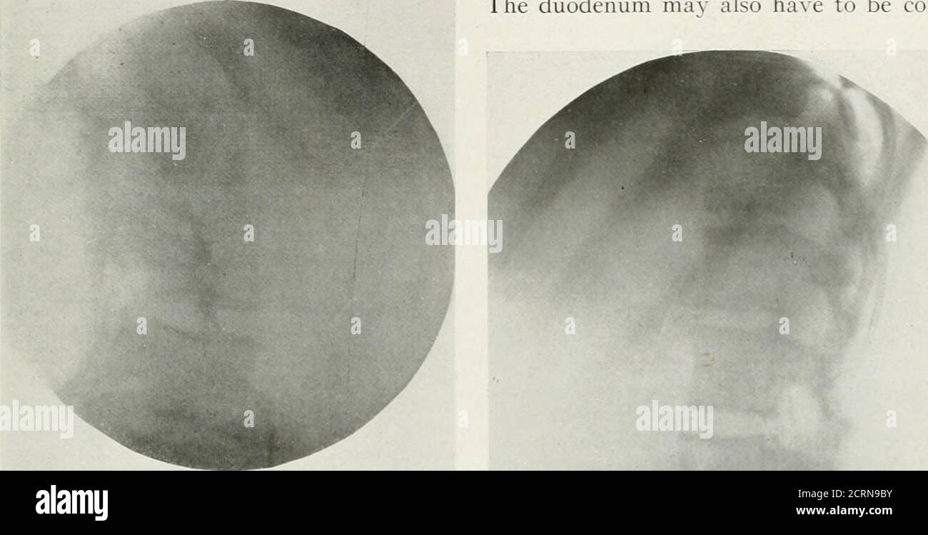 Psoas abszess -Fotos und -Bildmaterial in hoher Auflösung – Alamy
