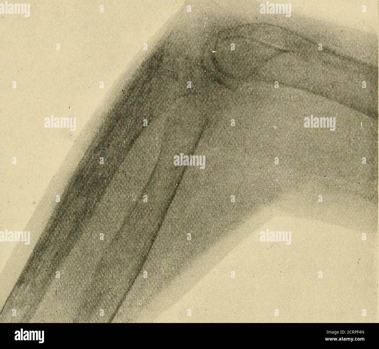 Types de fractures des os -Fotos und -Bildmaterial in hoher Auflösung ...