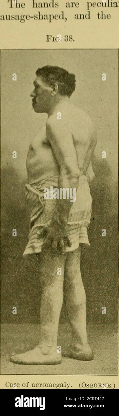 Osteitis deformans -Fotos und -Bildmaterial in hoher Auflösung – Alamy