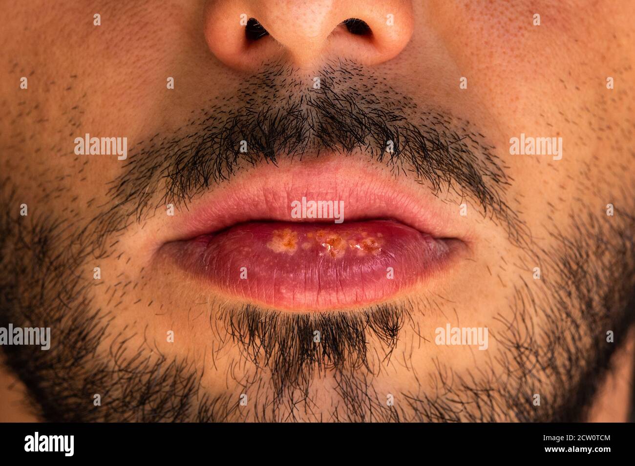 Herpes lips -Fotos und -Bildmaterial in hoher Auflösung – Alamy