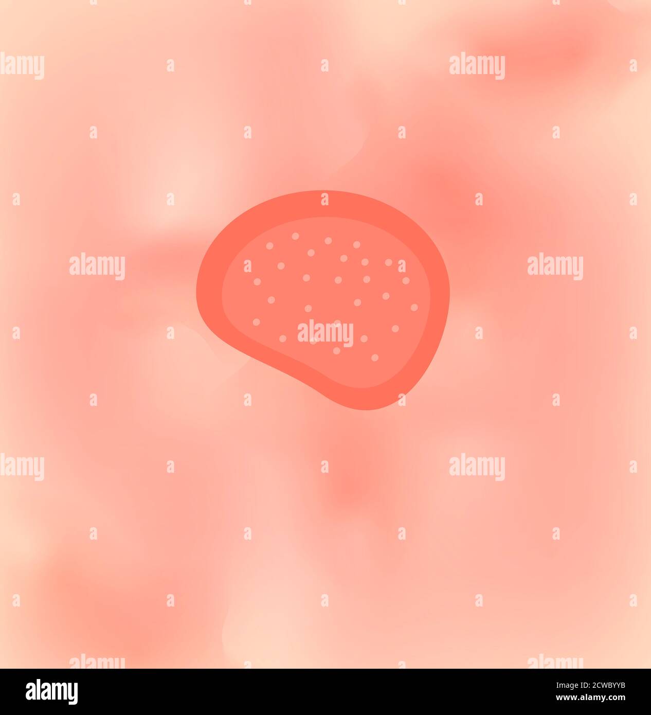 Ringwurm Der Kopfhaut Stockfotos und -bilder Kaufen - Alamy