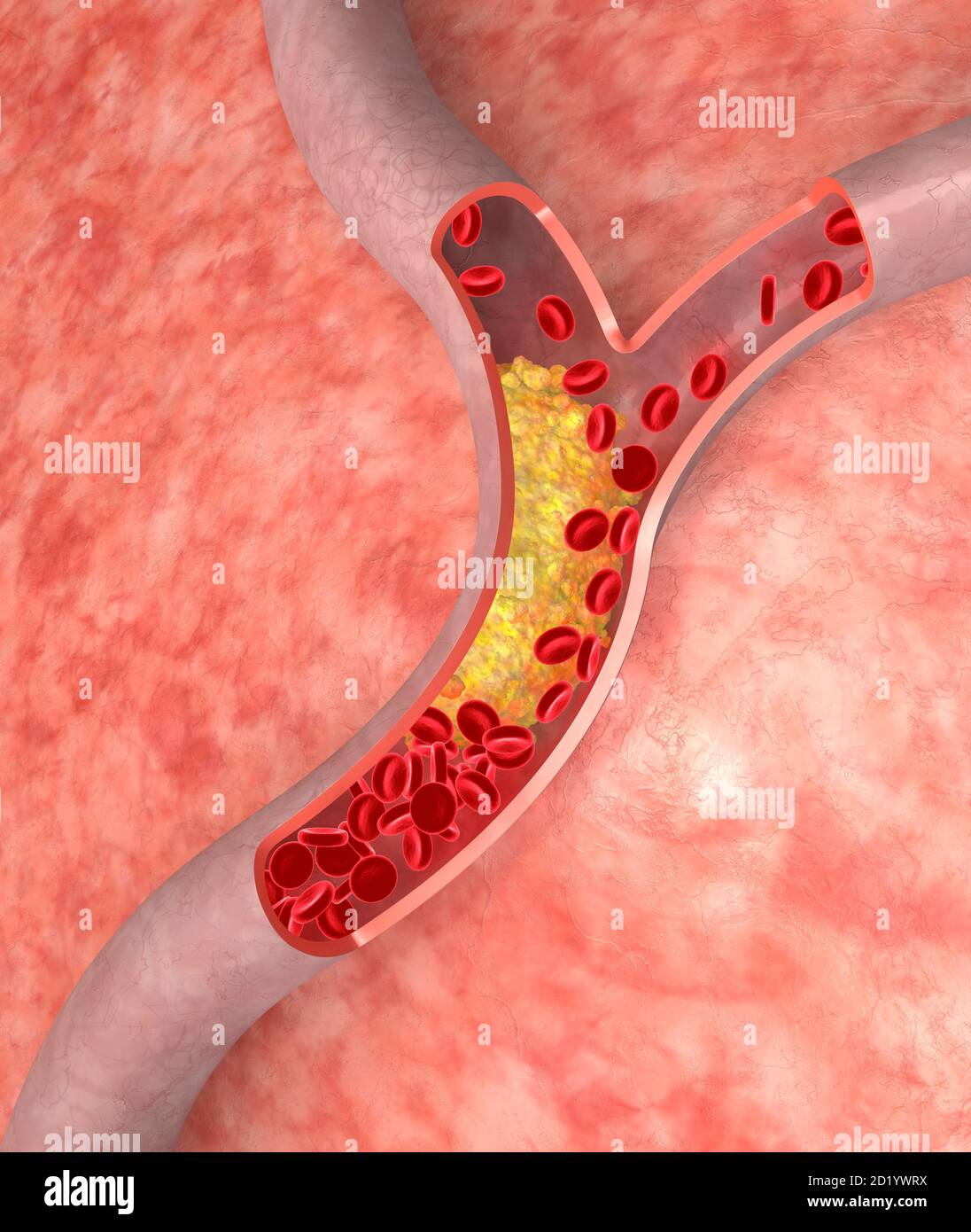 Illustration for atherosclerosis -Fotos und -Bildmaterial in hoher ...