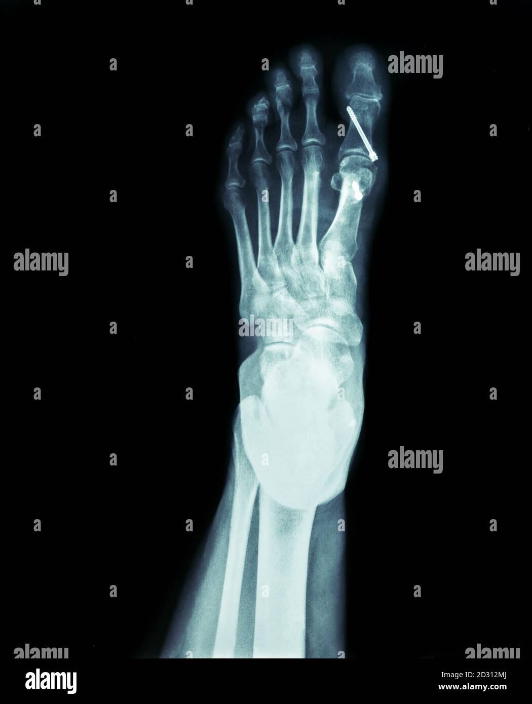 Röntgenbild fuss hallux valgus -Fotos und -Bildmaterial in hoher ...