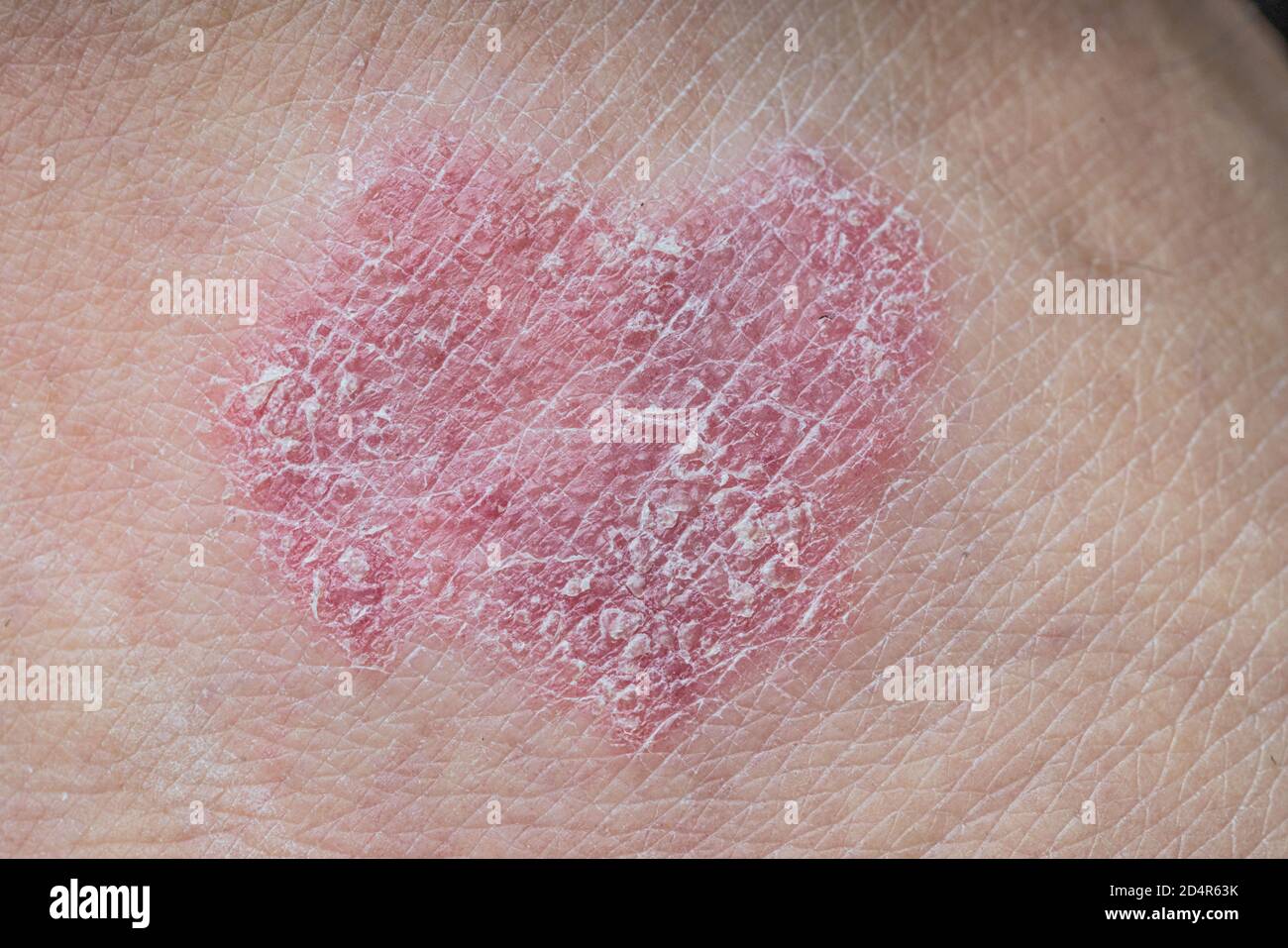 Psoriasis nahaufnahme -Fotos und -Bildmaterial in hoher Auflösung – Alamy
