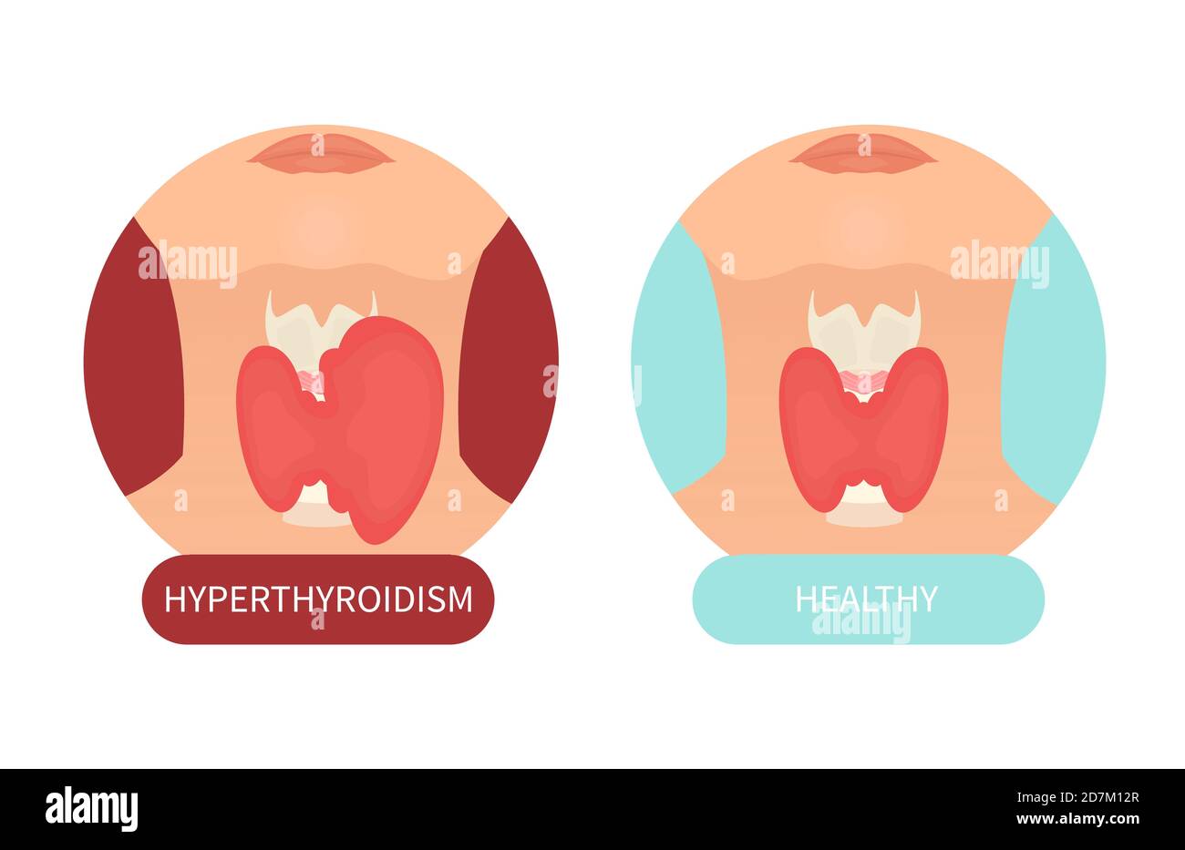 Thyroid gland medical illustration -Fotos und -Bildmaterial in hoher ...
