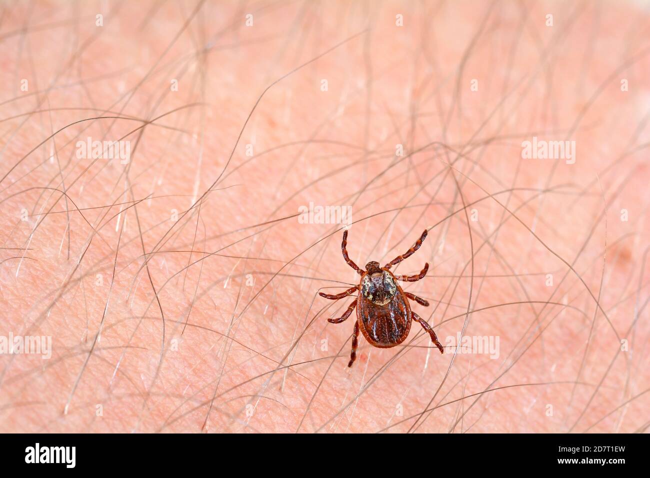 Gefahr von Zeckenbiss. Milbe auf der Haut Stockfotografie - Alamy