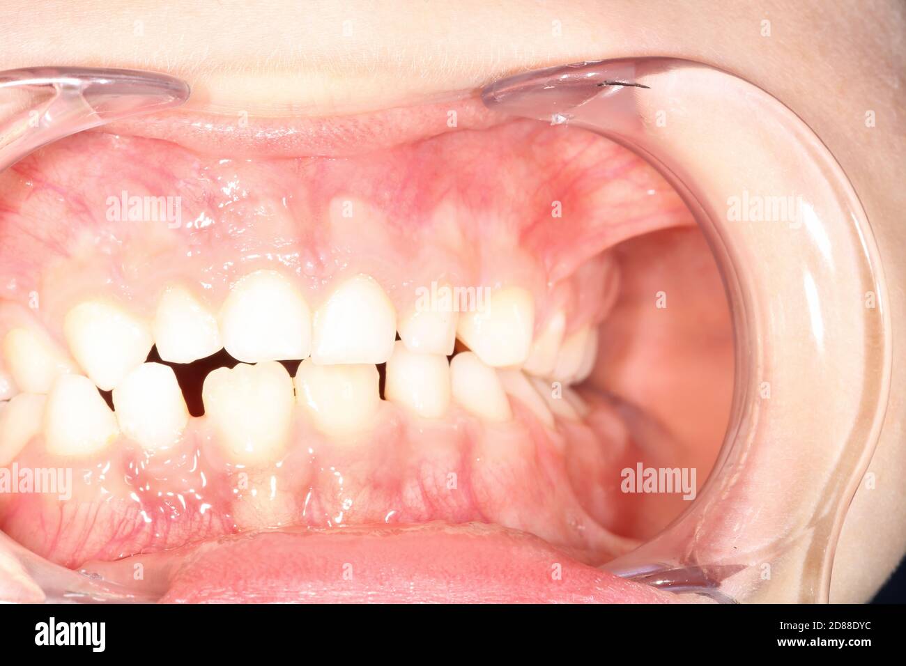 Child rotten teeth -Fotos und -Bildmaterial in hoher Auflösung – Alamy