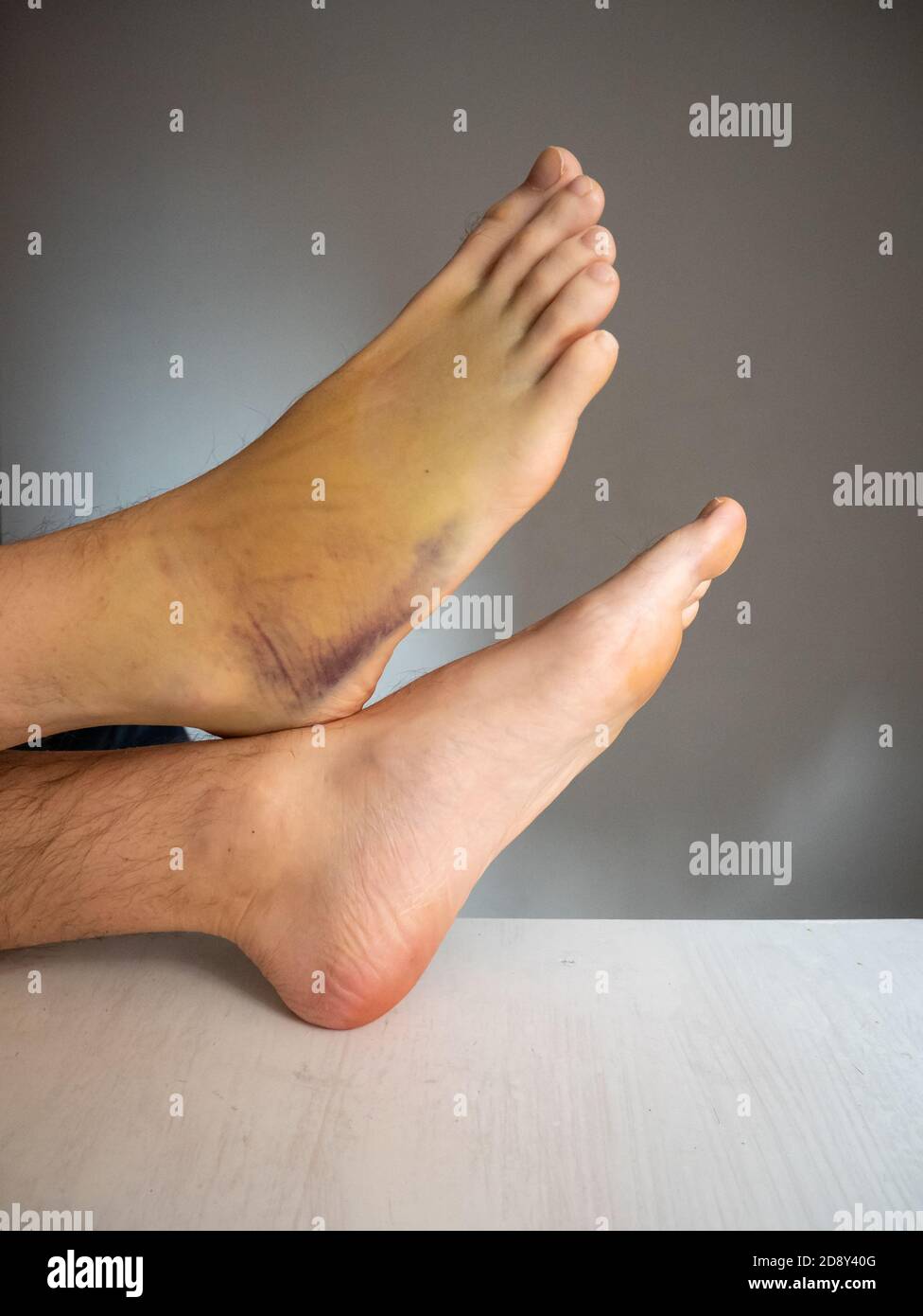 Rechter Fuß Prellung, auch bekannt als Prellung auf einem großen ...