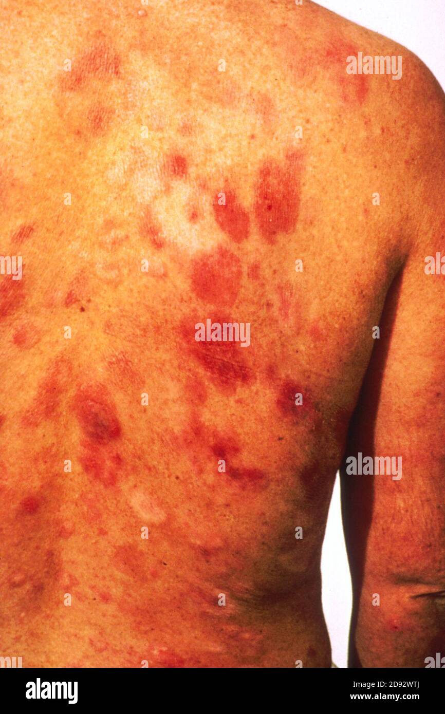 Kaposi's sarcoma -Fotos und -Bildmaterial in hoher Auflösung – Alamy
