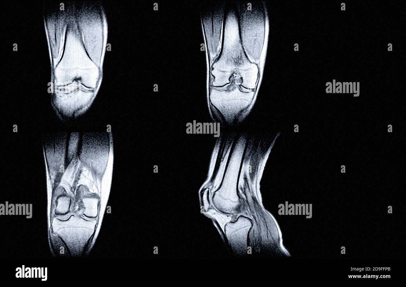 Knee Joint Mri Stockfotos und -bilder Kaufen - Alamy