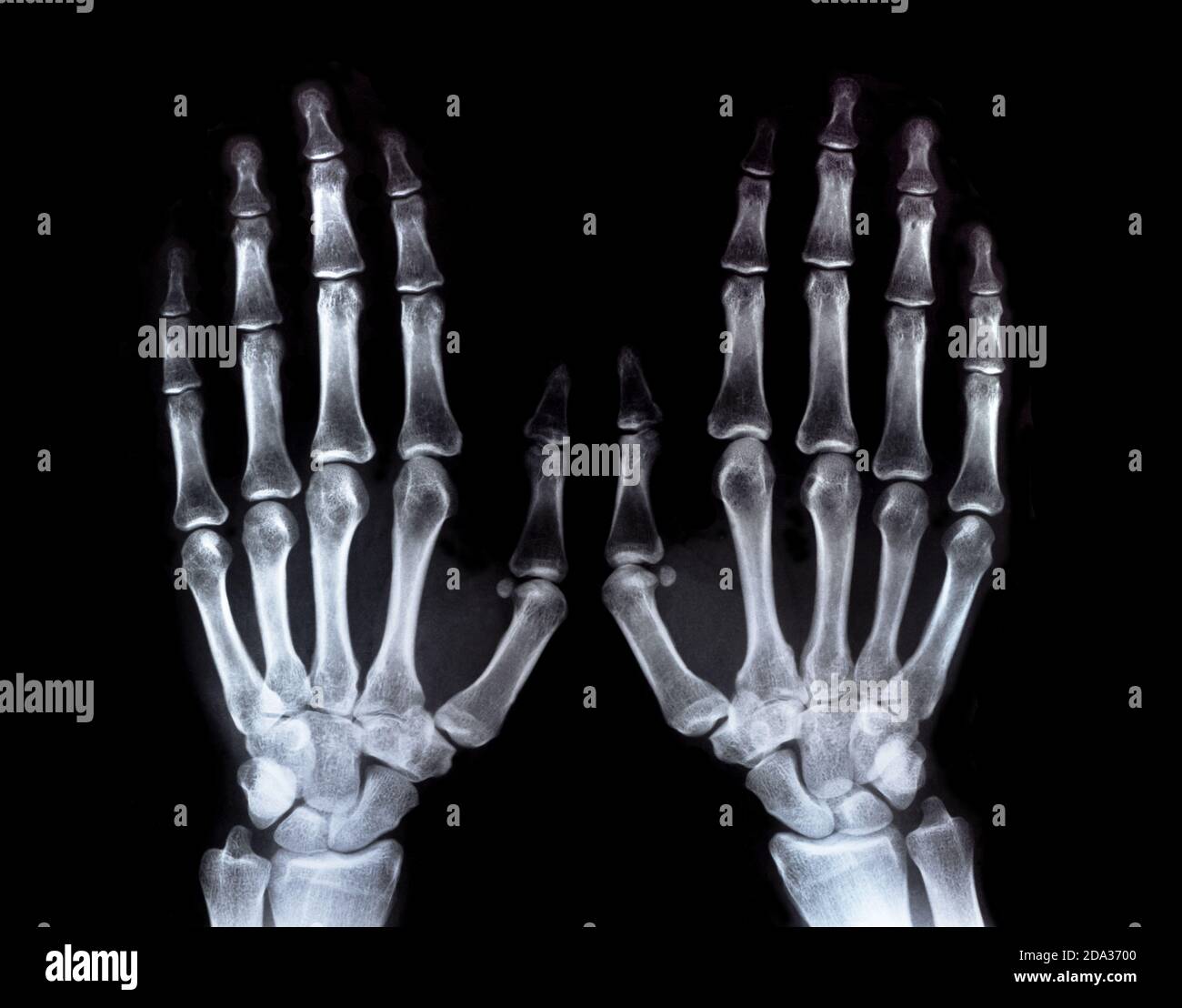 Arthritis hands xray -Fotos und -Bildmaterial in hoher Auflösung – Alamy