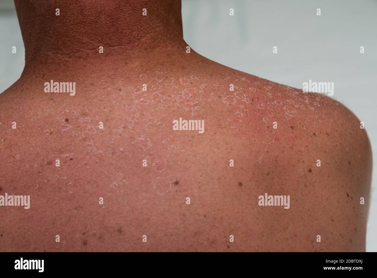 Dermatitis Solaris Stockfotos und -bilder Kaufen - Alamy