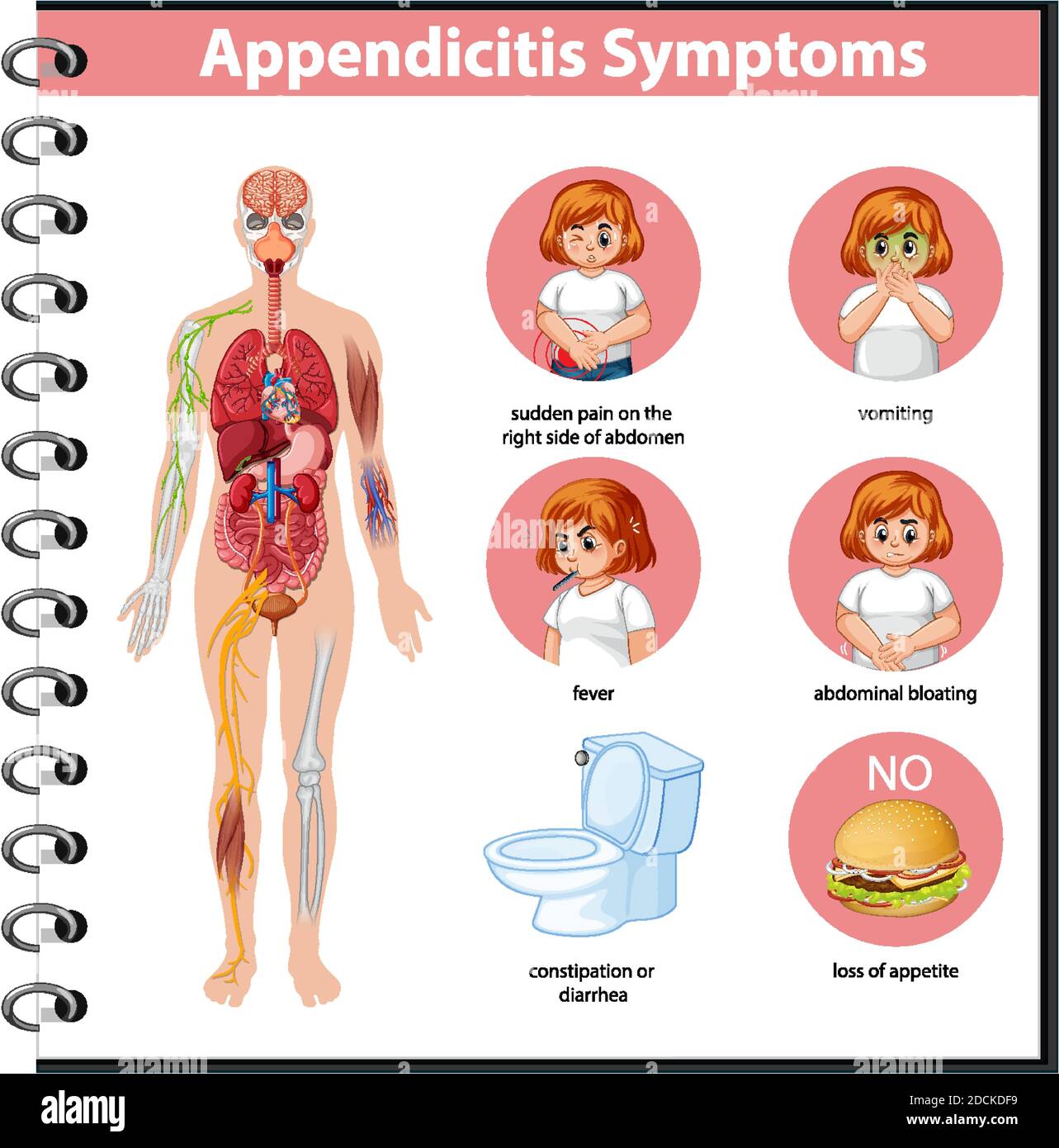Infografik zur Beschreibung der Symptome von Appendizitis Stock ...