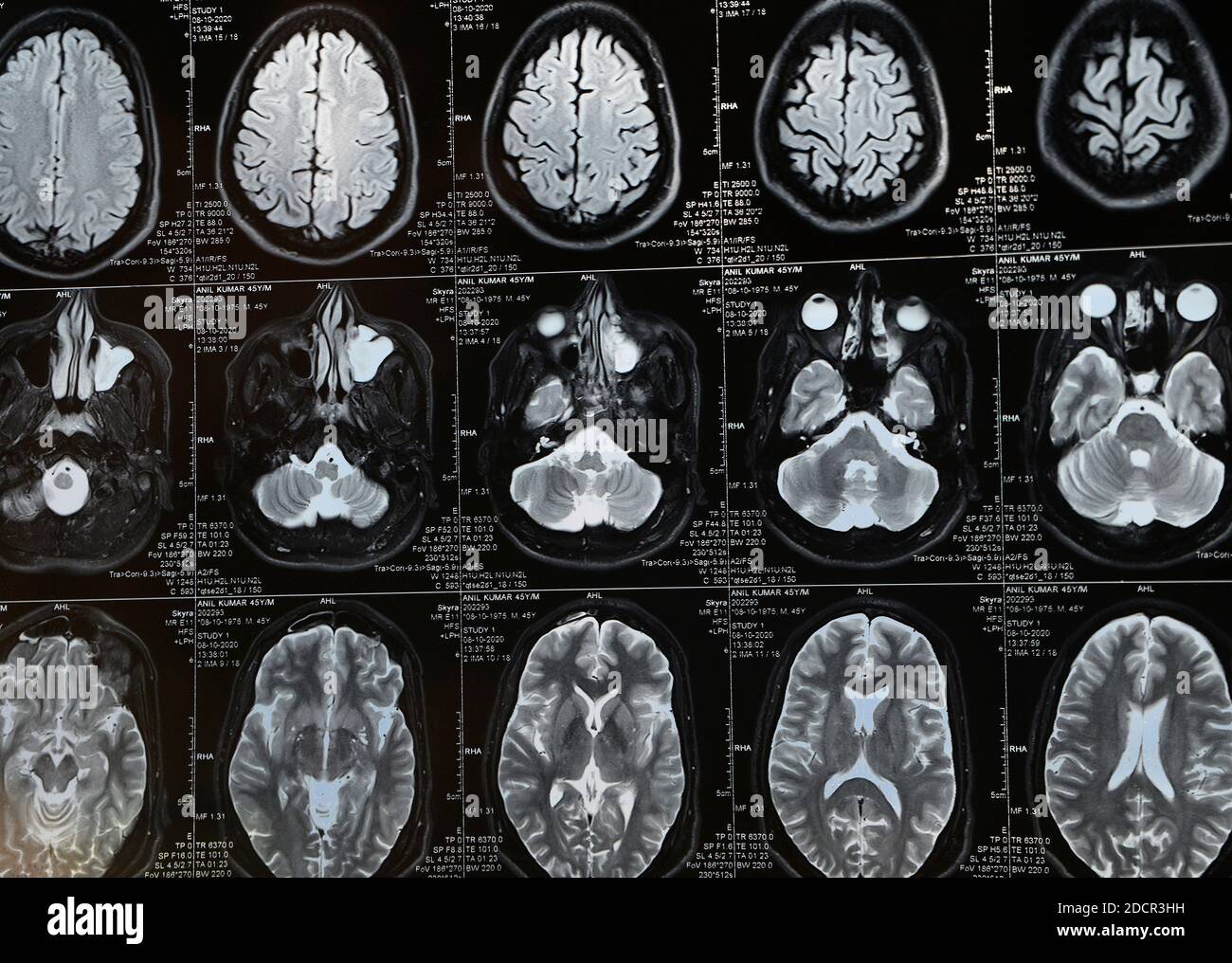 Mrt-Brain Scan von Kopf und Schädel Stockfotografie - Alamy