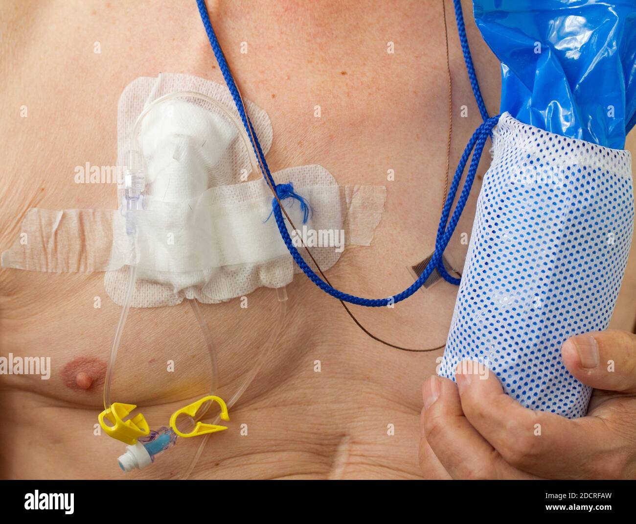 Krebs chemotherapie -Fotos und -Bildmaterial in hoher Auflösung – Alamy